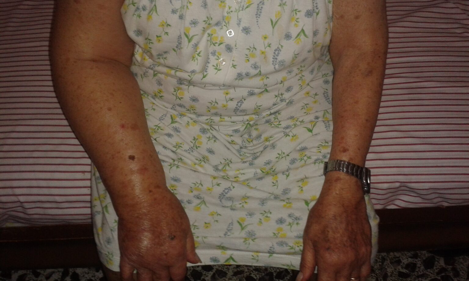 Λεμφοίδημα. Συμπτώματα, Αιτίες, Στάδια και Θεραπεία – ΚΕΝΤΡΟ ΘΕΡΑΠΕΙΑΣ ...